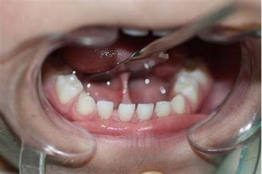Frenillo sublingual corto o anquiloglosia: qué debo saber